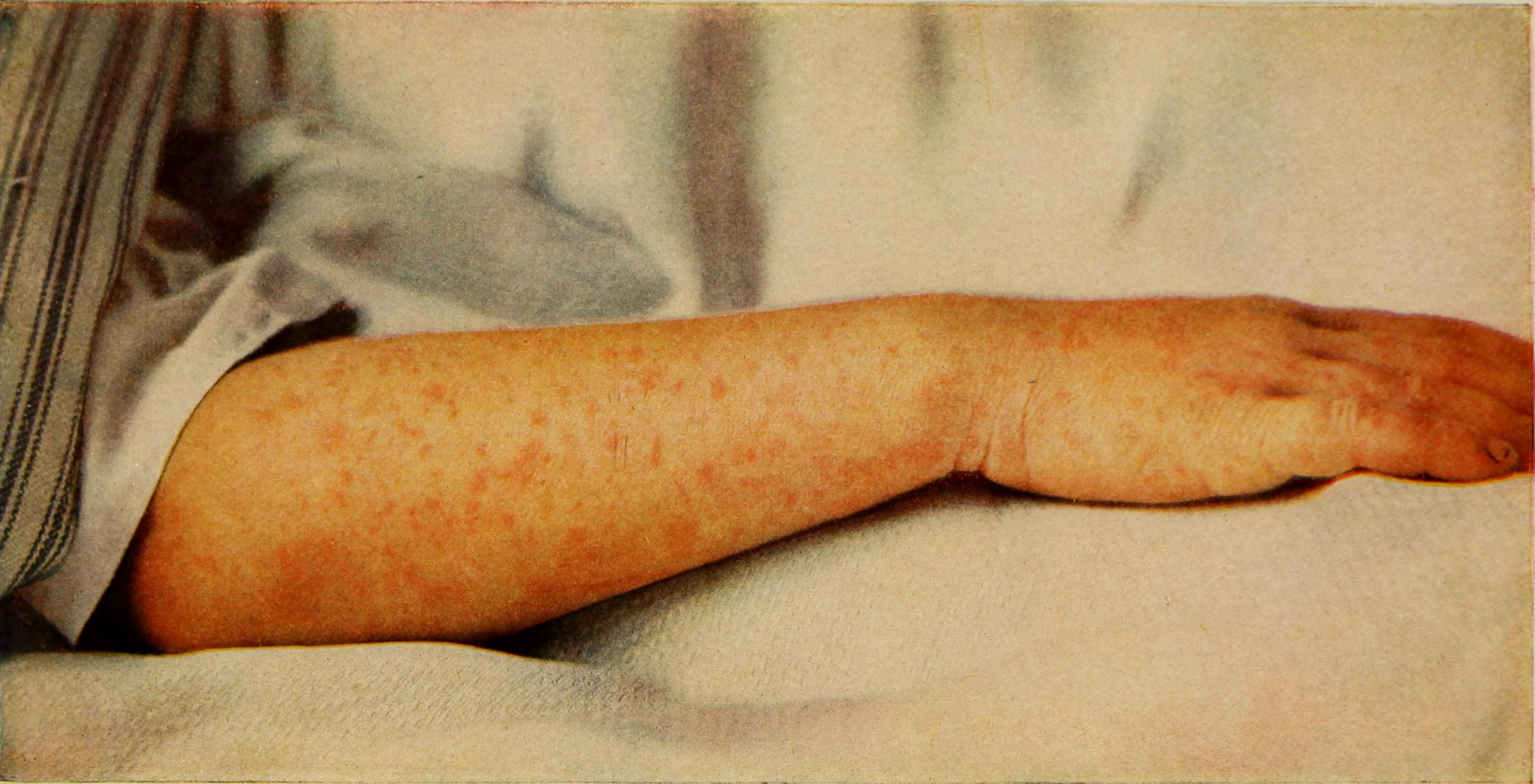 Scarlet fever cases in England reach 50 year high - Muslim News UK
